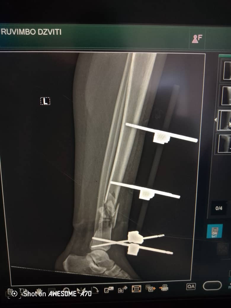 Leg Pain & Rehab | Natalie Cutten – Morningside Physio Care